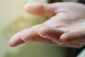 Xerosis & Winter Itch: Why It Happens and How to Treat It | Seacoast ...